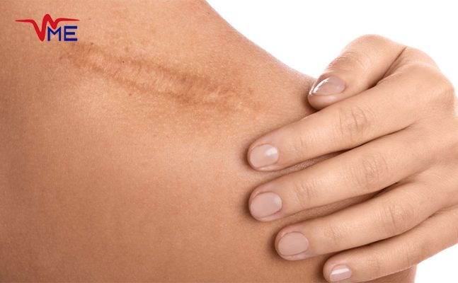 Advanced Scar Treatments with Laser Therapy for Smoother Skin ...