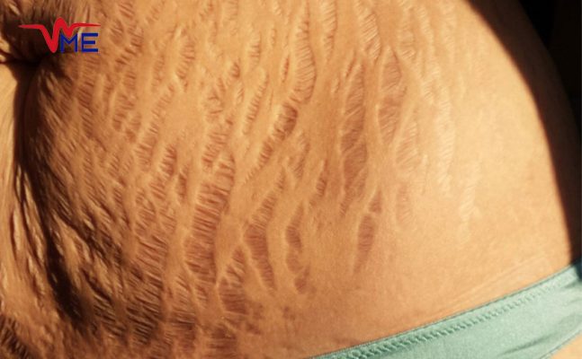 Advanced Scar Treatments with Laser Therapy for Smoother Skin ...